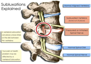 What is Subluxation? - Jenkins Family Chiropractic